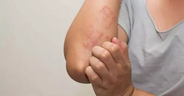 Dermatitis de contacte: tipus, símptomes, tractaments i millors remeis