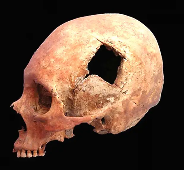 Trepanation - පුරාණ වෛද්ය විද්යාවේ ආශ්චර්යයකි