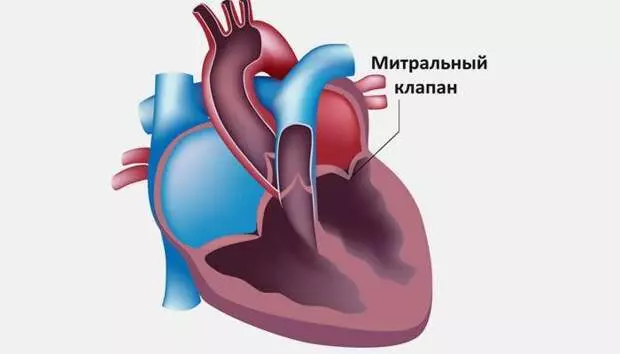 Mitrális billentyű prolapsus 1 fok