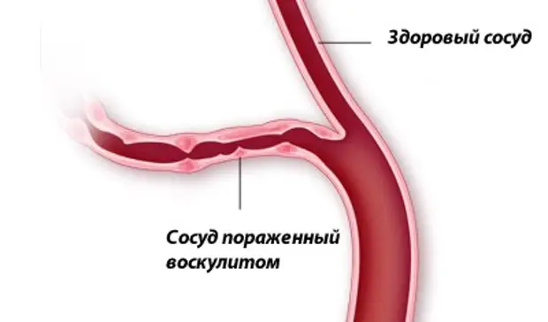 Zdjęcia na żądanie Krwotoczne zapalenie naczyń