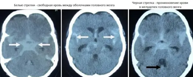 Чхання закритим ротом убиває. Клінічні випадки