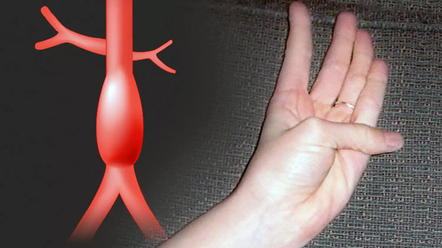 Der Finger zeigt: Wie man ein Aortenaneurysma im Voraus erkennt