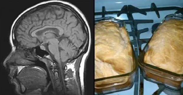 Waspada - Penyakit Alzheimer! Ing ngisor iki sawetara panganan kanggo njaga otakmu