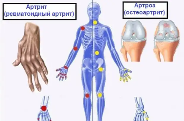 Itandukaniro hagati ya arthrosis, arthritis na osteoporose: ugomba kumenya!