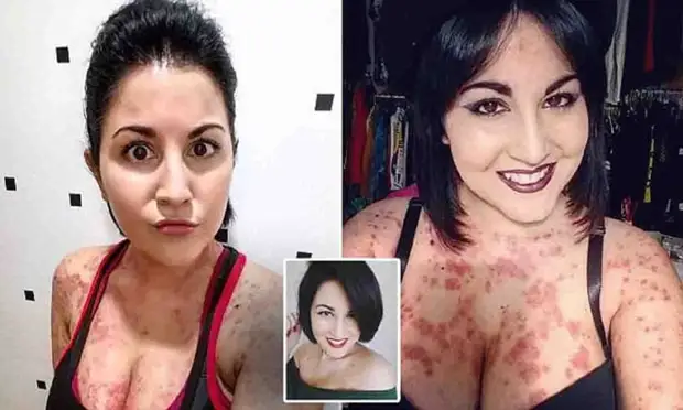 په psoriasis اخته نجلۍ پرته له شرم، ناروغۍ، عکس څخه د هغې ښکلا ښودلو څخه ډډه کوي