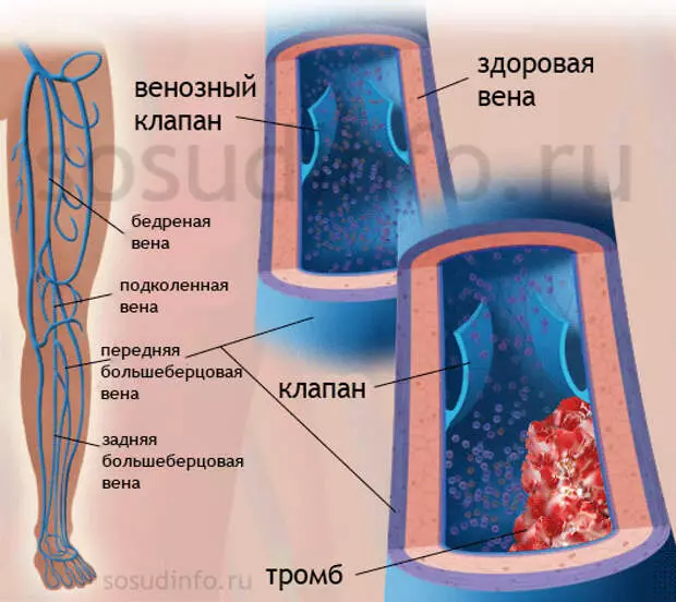 Tromboflebitída hlbokých a povrchových žíl: akútna a chronická. Diagnostika, liečba, prevencia