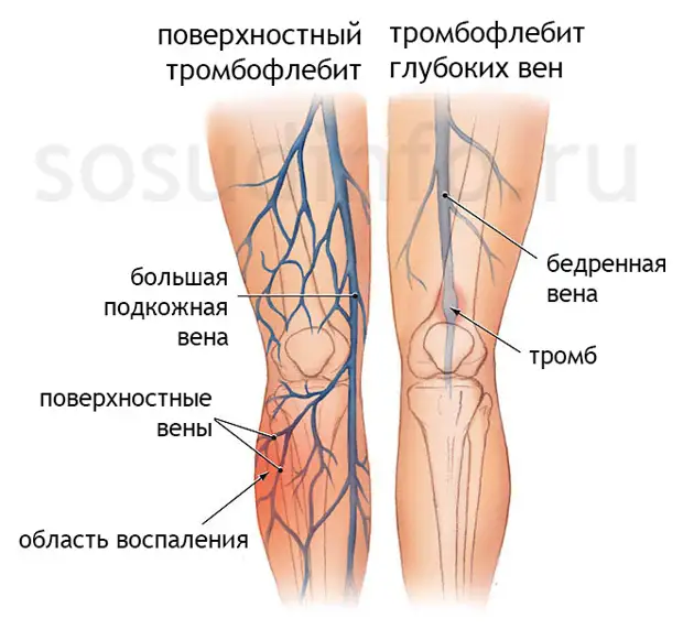 Thrombophlebitis ຂອງເສັ້ນກ່າງຜິວເນື້ອສີຂາແລະເລິກ