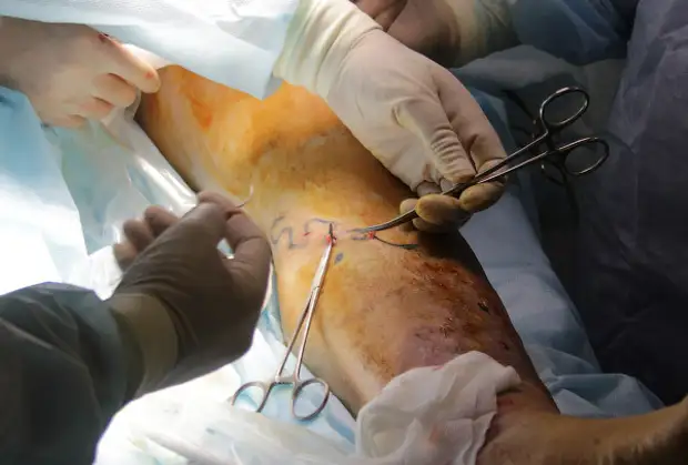 How varicose veins are operated on - How it is done, how it works, how it works