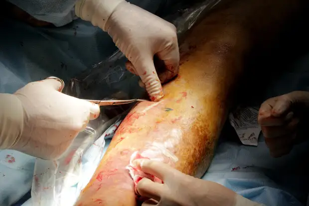 How varicose veins are operated on - How it is done, how it works, how it works