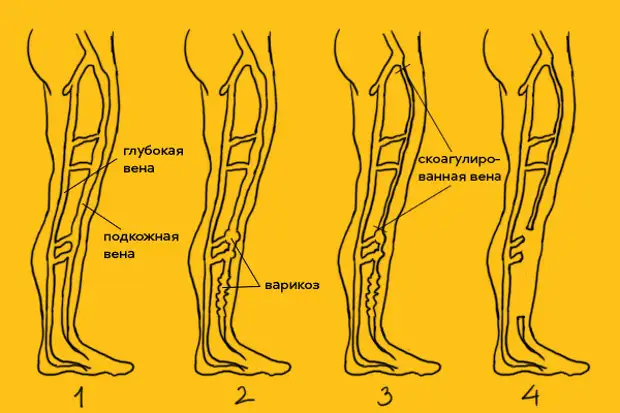 How varicose veins are operated on - How it is done, how it works, how it works