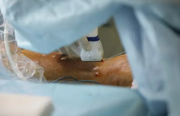 How varicose veins are operated on - How it is done, how it works, how it works