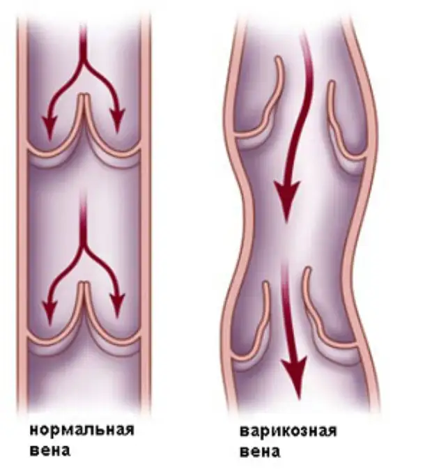 ویریکوز رگوں کی تصاویر