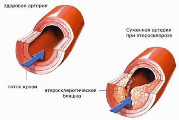 Бузургтарин қаллобӣ дар асри 20. Холестирин