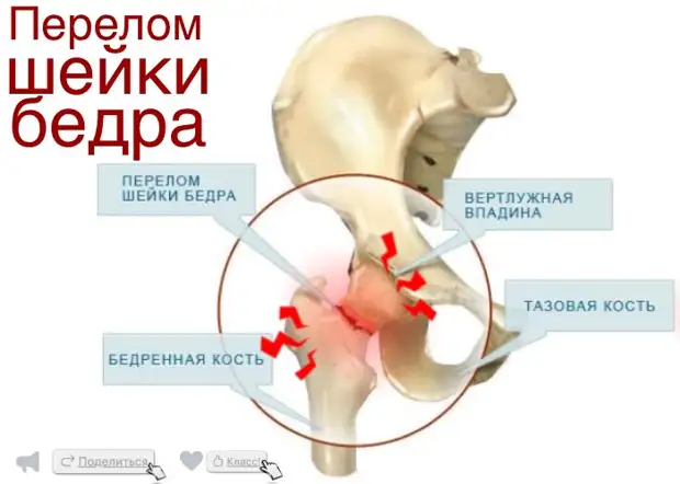 Femoral neck fracture: sintomas, pagdayagnos, pagtambal