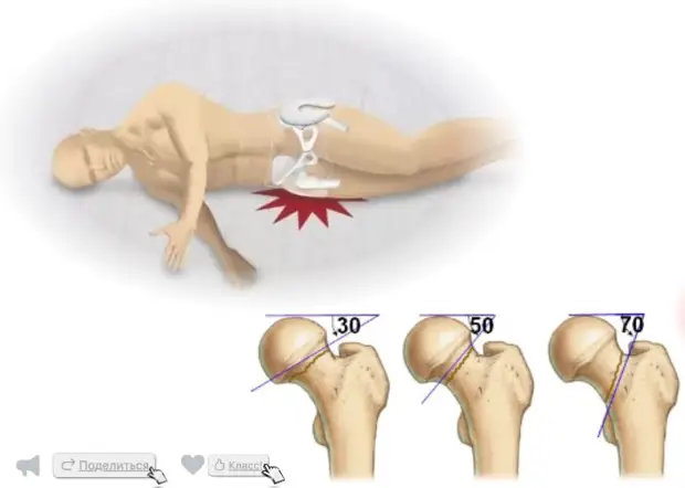 Femoral neck fracture: sintomas, pagdayagnos, pagtambal