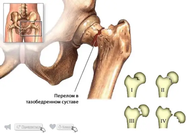 Femoral neck fracture: sintomas, pagdayagnos, pagtambal