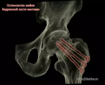 Femoral neck fracture: sintomas, pagdayagnos, pagtambal