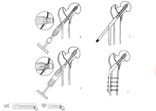 Femoral neck fracture: sintomas, pagdayagnos, pagtambal