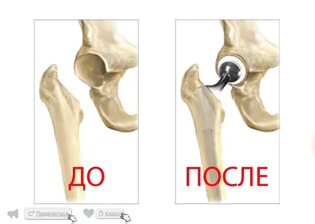 Femoral neck fracture: sintomas, pagdayagnos, pagtambal