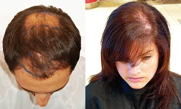 Talap boýunça Alopekiýa suratlaryny saç hünärmeni bejermeli