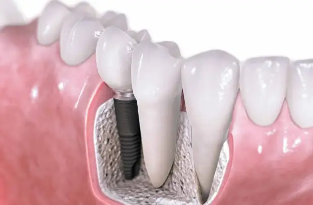 Implantên diranan hatine çêkirin ku dikarin bi serê xwe di hestî de mezin bibin