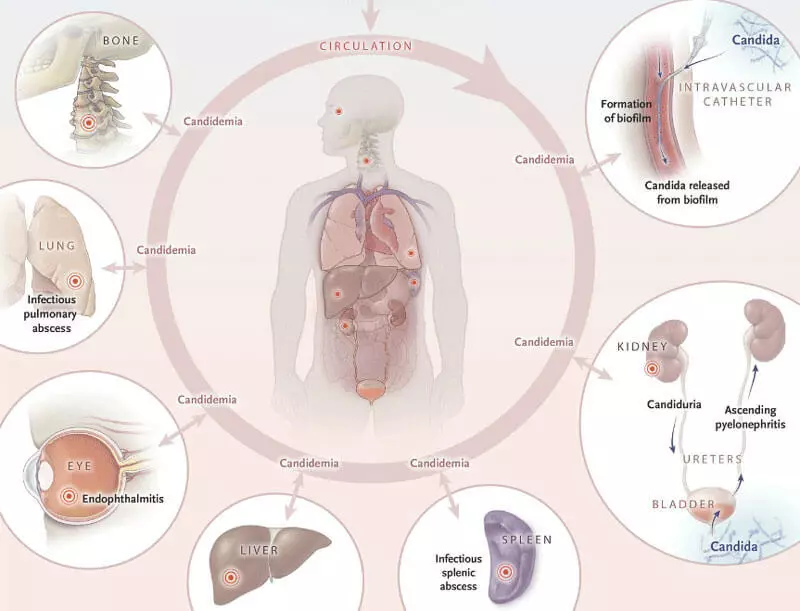 Warning signs of the presence of fungi in the body: What to do