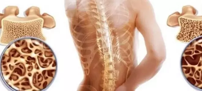 come evitare l'osteoporosi?