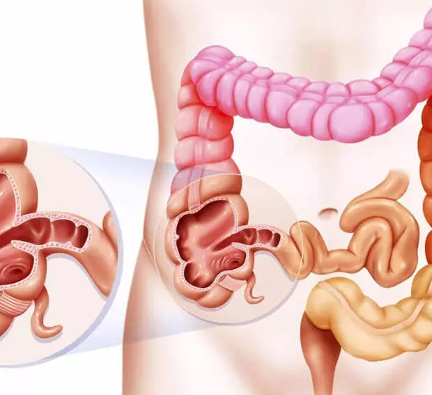 I-Leaky gut syndrome - ukuxilongwa kwenkulungwane ye-21