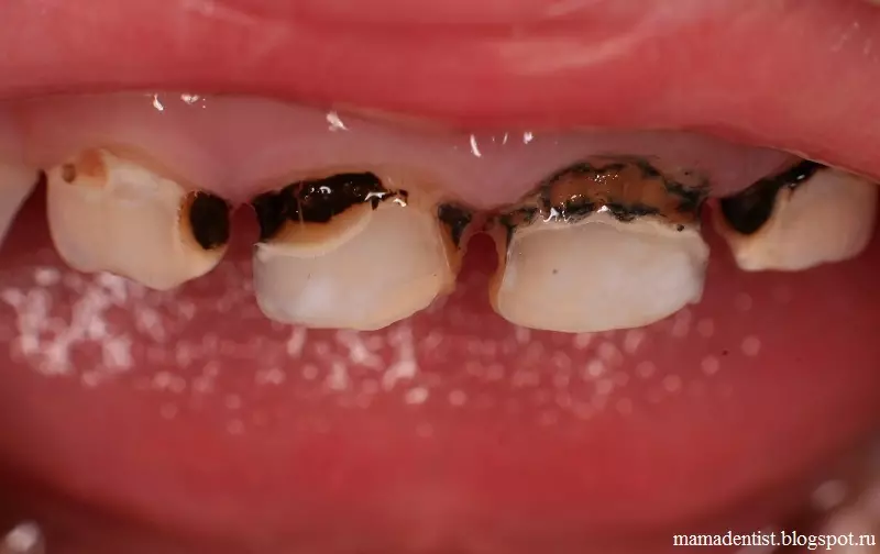 Comment la plaque dentaire se transforme en carie
