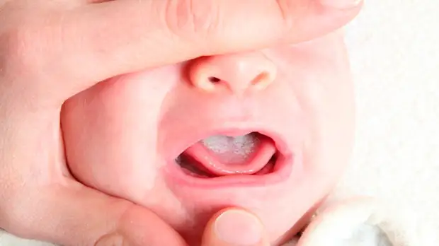 patina bianca sulla lingua di un bambino