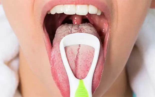 如何清除舌头上的氟化物斑块