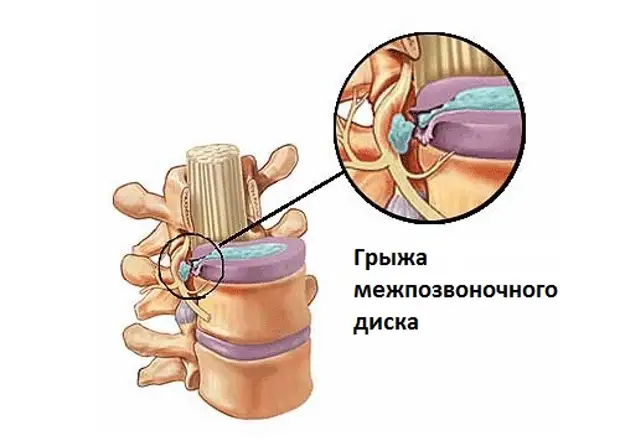 Mga sintomas ng herniated disc