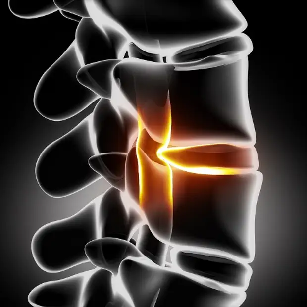 Herniated diskur með þrýstingi á mænu nærmynd