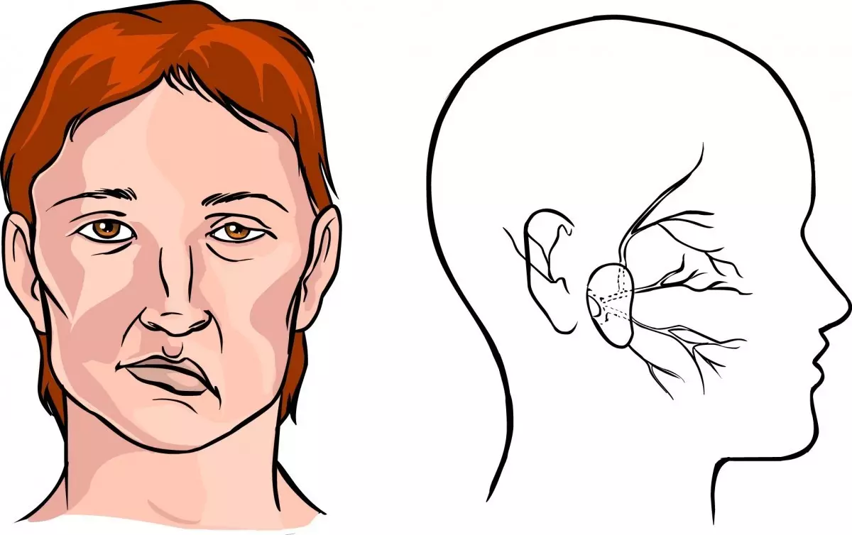 Motivele care provoacă un accident vascular cerebral sunt diferite și depind de tipul acestei boli. Există 2 tipuri de lovituri.