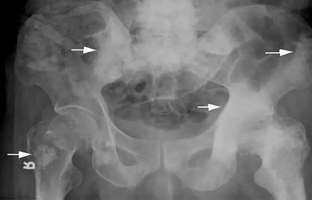 Rak prostate kod 2.250 godina stare egipatske mumije.