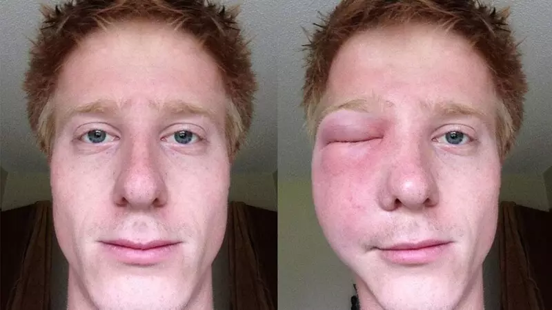 Cómo las alergias pueden matarte | ¿Qué es el edema de Quincke?