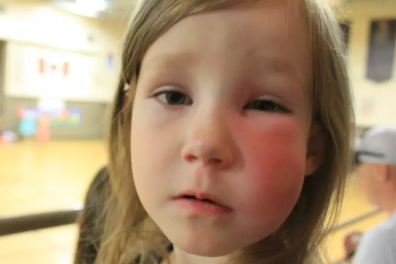 Jak vás alergie mohou zabít | Co je Quinckeho edém?