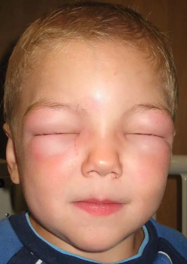 Аллергия сизди кантип өлтүрөт | Quincke шишиги деген эмне?