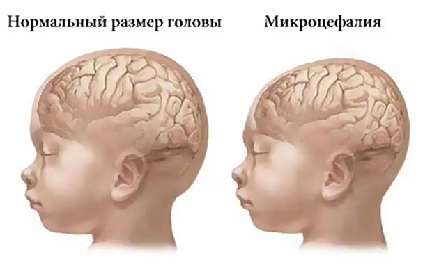 Zikos virusas: dar viena „sensacija“ ar reali grėsmė žmonijai?