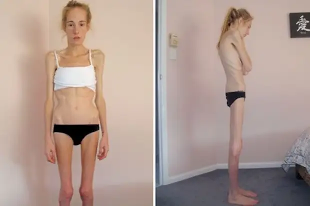 Före och efter: historia av anorektisk anorexi, anorexi, före och efter