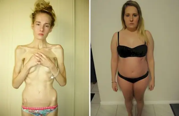 Előtte és utána: anorexiás anorexiás anamnézis, anorexia, előtte és utána