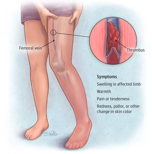 8 tekens van trombose wat gevaarlik is om te ignoreer
