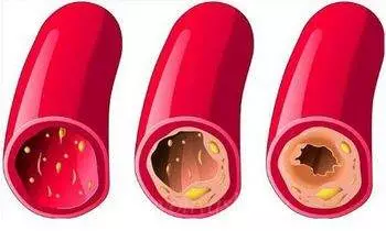 Como eliminar o inchazo da cara despois do alcohol na casa