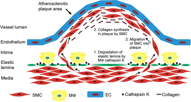 Cholesterin-Plaque