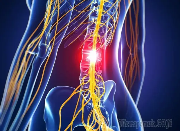 Sciatica, awọn aami aisan ati itọju pẹlu awọn atunṣe eniyan