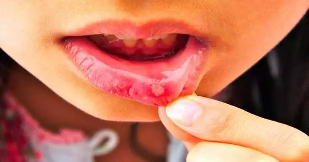 Stomatitis di murangkalih - kumaha ngakuan sadaya jinis sareng gancang ngubaran panyakit?