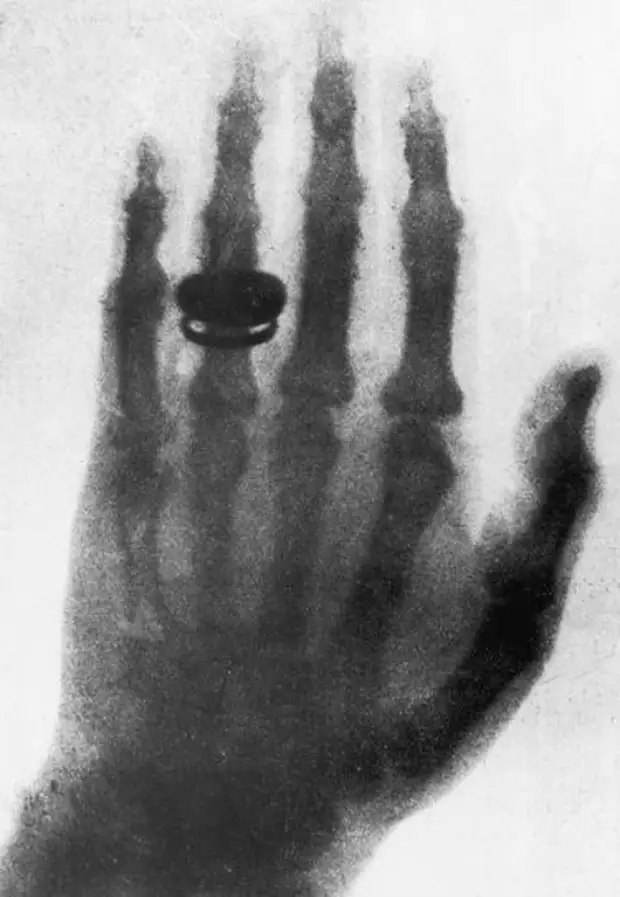 x-ray ane makore zana nemakumi maviri, x-rays inonakidza, x-ray inokatyamadza
