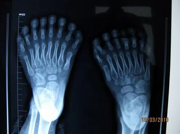 Röntgenbild 120 Jahre alt, interessanteste Röntgenbilder, schockierende Röntgenbilder