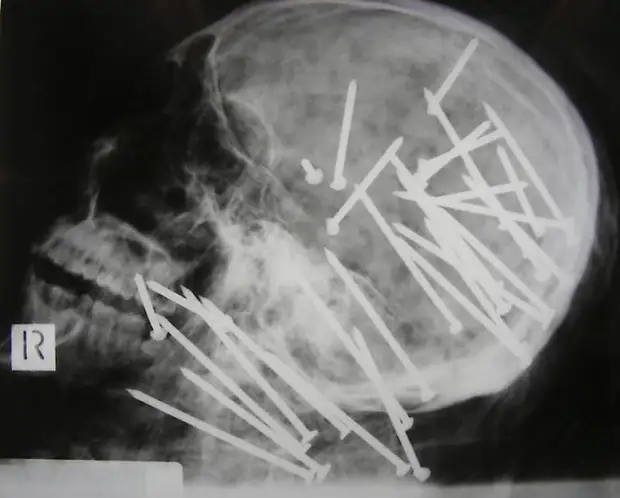 צילום רנטגן בן 120, צילומי רנטגן מעניינים ביותר, צילומי רנטגן מזעזעים
