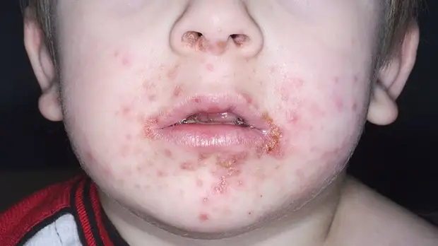 Thumela malunga ne-impetigo